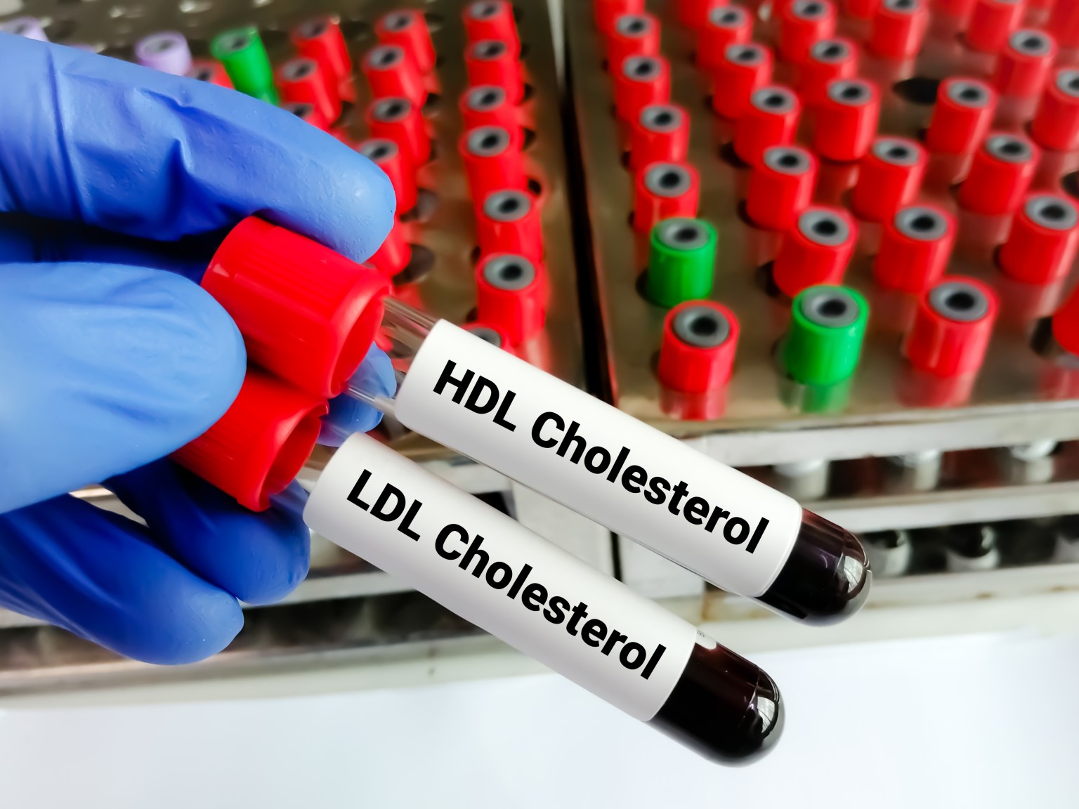 Understanding Cholesterol Levels and Numbers | Dr. Berg