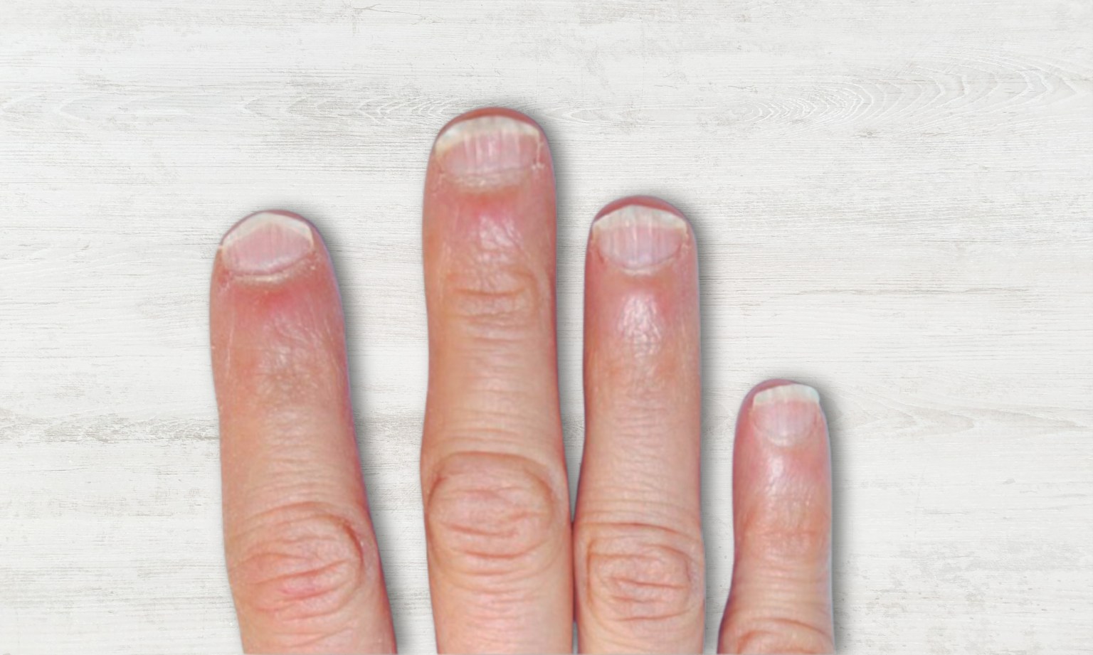 Spoon Shaped Nails: What You Need to Know | Dr. Berg