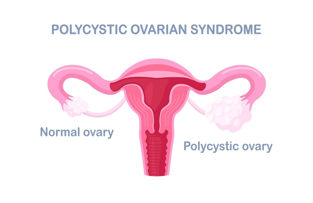 What Is Polycystic Ovarian Syndrome (PCOS)? | Dr. Berg