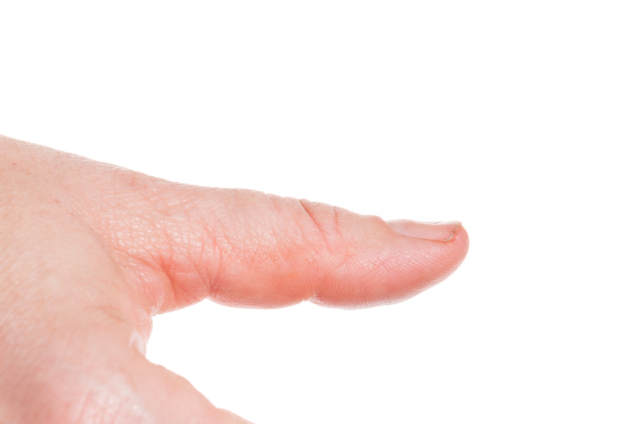 Vitamin Deficiency Nails 7 Signs of Deficiencies | Dr. Berg