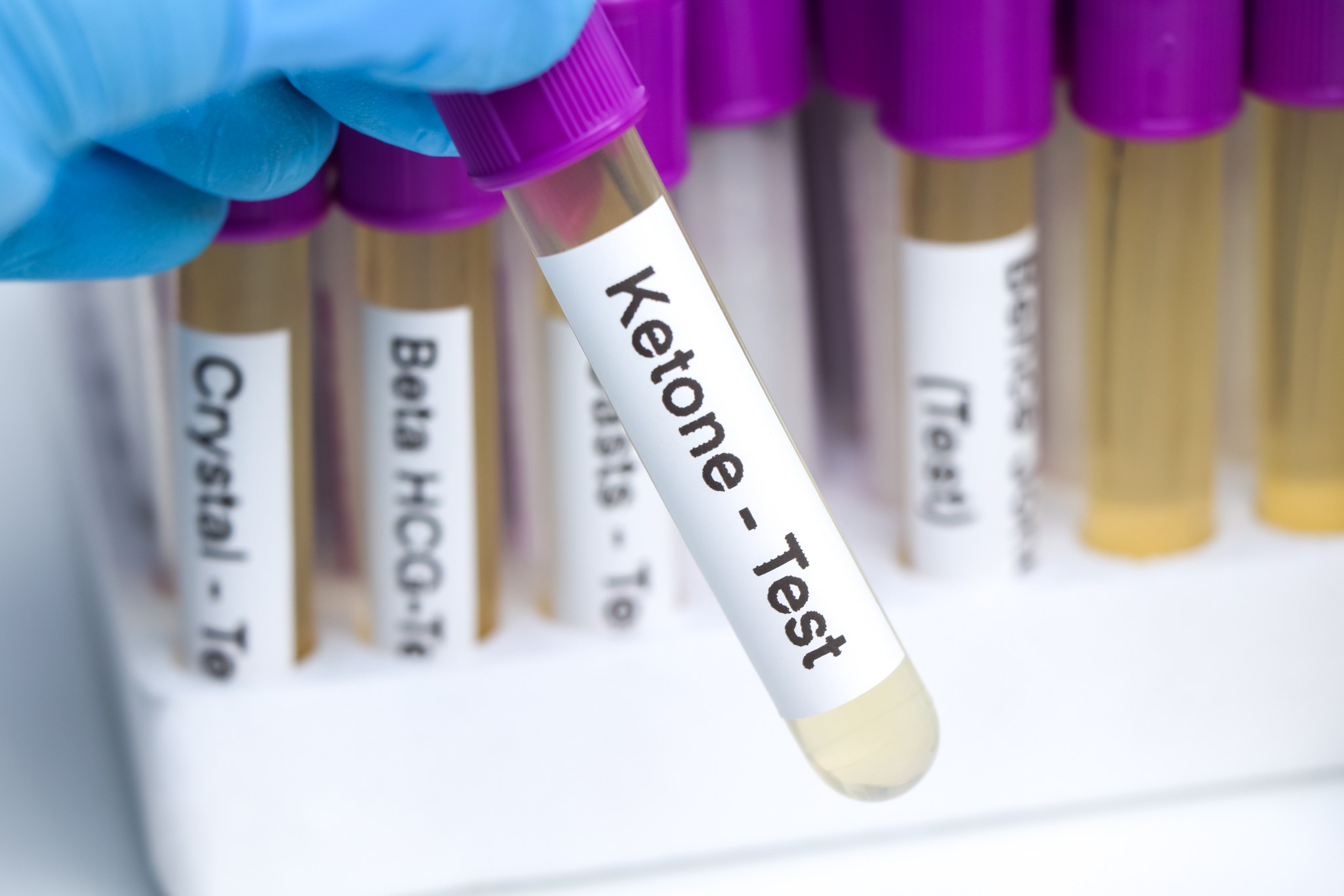 Ketones in Urine: Why You Might Not See Them | Dr. Berg