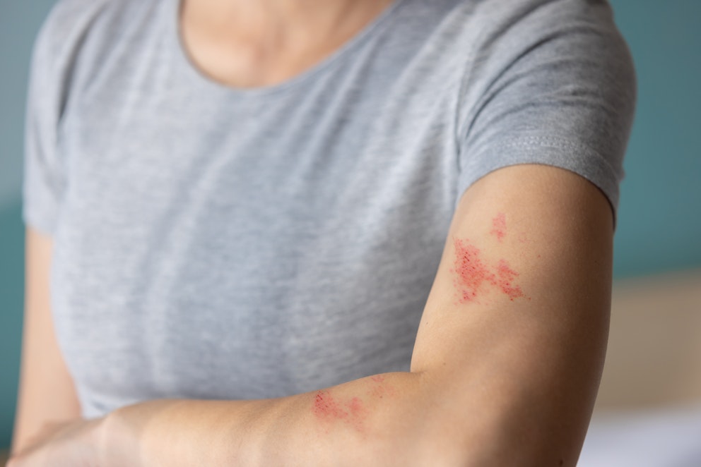 Vitamin D and Shingles: Key Connection Explained | Dr. Berg